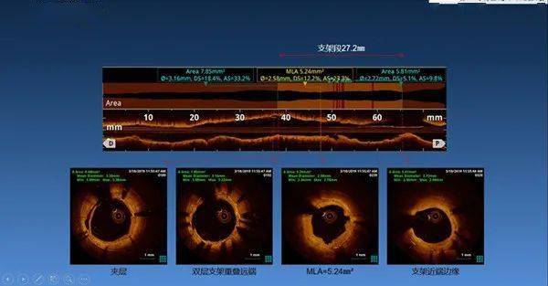 Safety Gained 充分预处理专题 | OCT指导下应用NSE棘突球囊治疗ISR一例-搜狐大视野-搜狐新闻