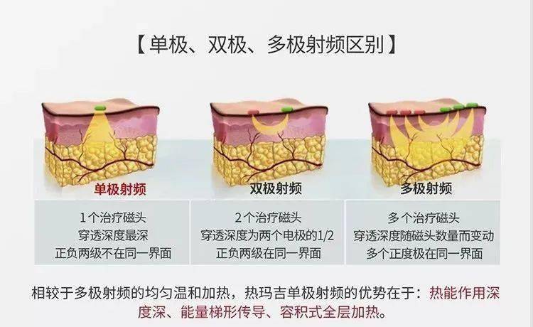 热玛吉4代CPT和5代FLX干货详解_治疗