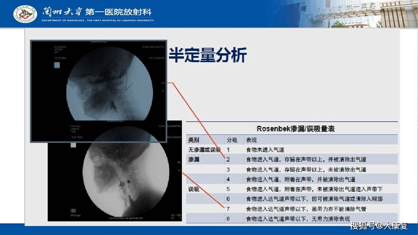 吞咽造影检查(VFSS)-搜狐大视野-搜狐新闻