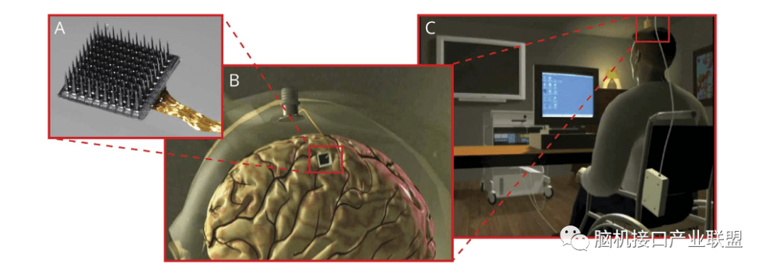 BrainGate发布植入神经接口系统临床试验的安全记录结果_安全性_参与者_研究