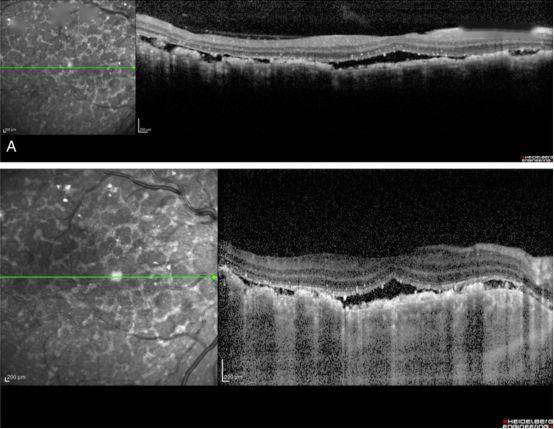 一篇文献+一个病例认识一个罕见病-双眼弥漫性葡萄膜黑色素细胞增生(BDUMP)_患者