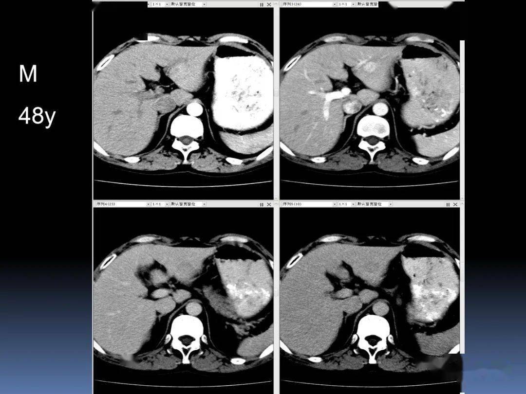 FNH的影像诊断_动脉
