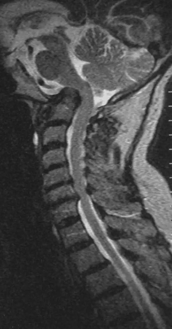 疼痛解剖学｜寰枢关节不稳：Sharp Purser试验-搜狐大视野-搜狐新闻