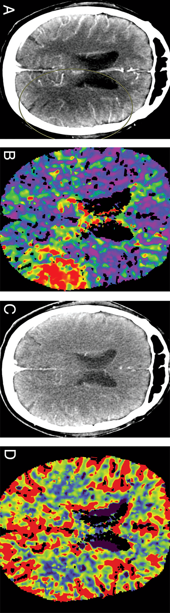 AJNR：多时相CTA在血管内治疗中的应用示例_动脉