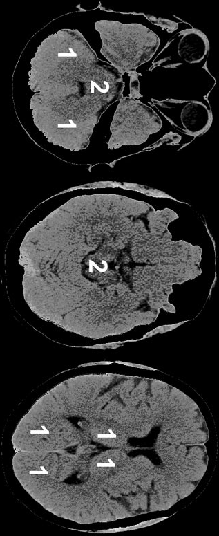 Stroke：pc-ASPECTS评分对基底动脉闭塞血管内治疗的价值_研究