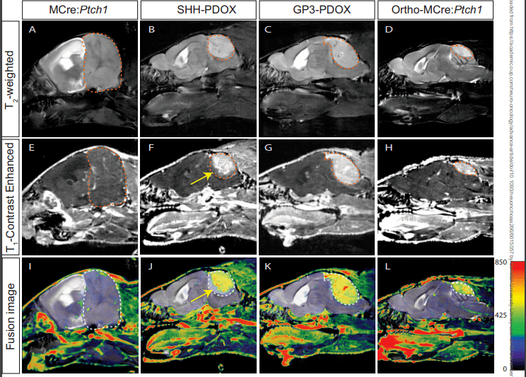 【期刊速览】《Neuro-Oncology》2021年5月文章_环状