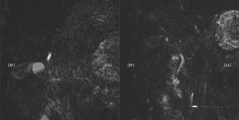 MRCP成像中的几个技术要点！_扫描