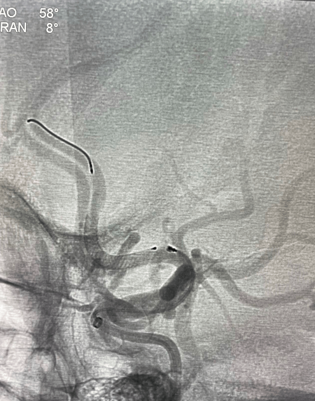 送无阻、顺必达—Phenom™ 27微导管在前循环远端血管中的应用_支架_Flex_血流