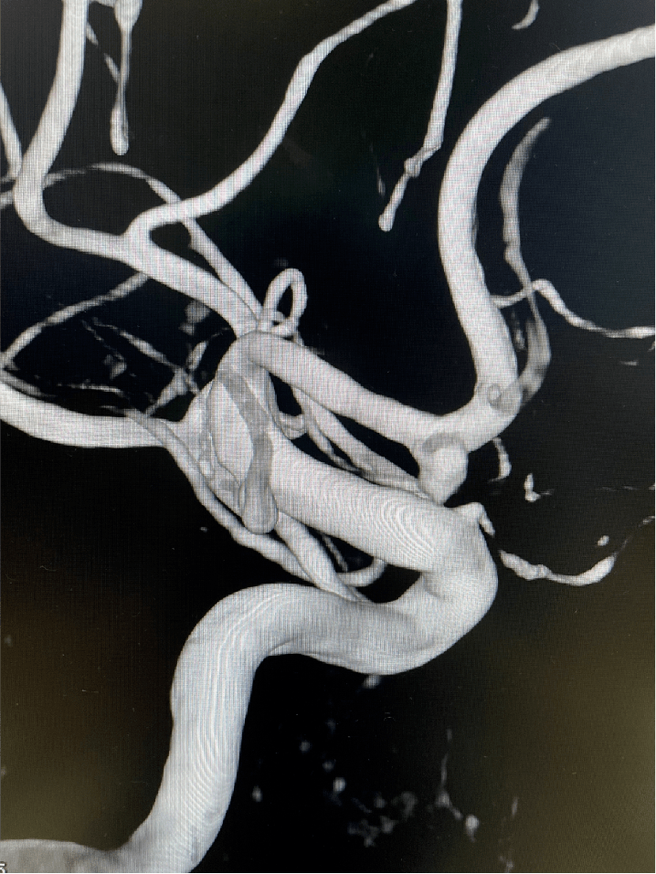 送无阻、顺必达—Phenom™ 27微导管在前循环远端血管中的应用_支架_Flex_血流