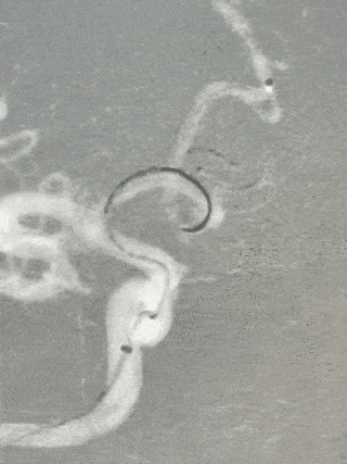 送无阻、顺必达—Phenom™ 27微导管在前循环远端血管中的应用_支架_Flex_血流