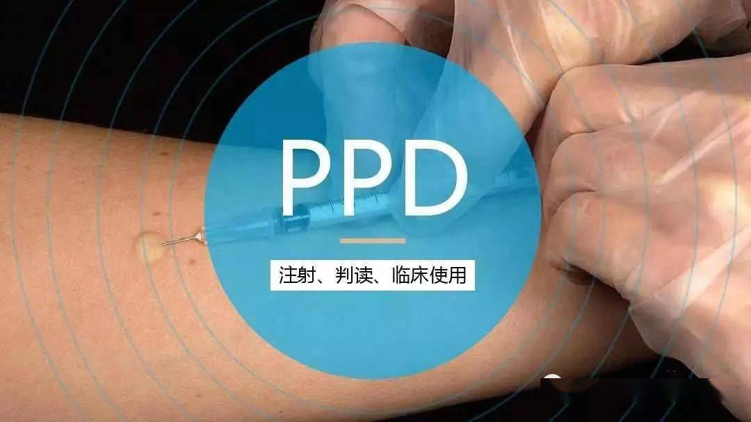 PPD试验结果呈阳性，是患有结核病吗？_反应_mm_卡介苗