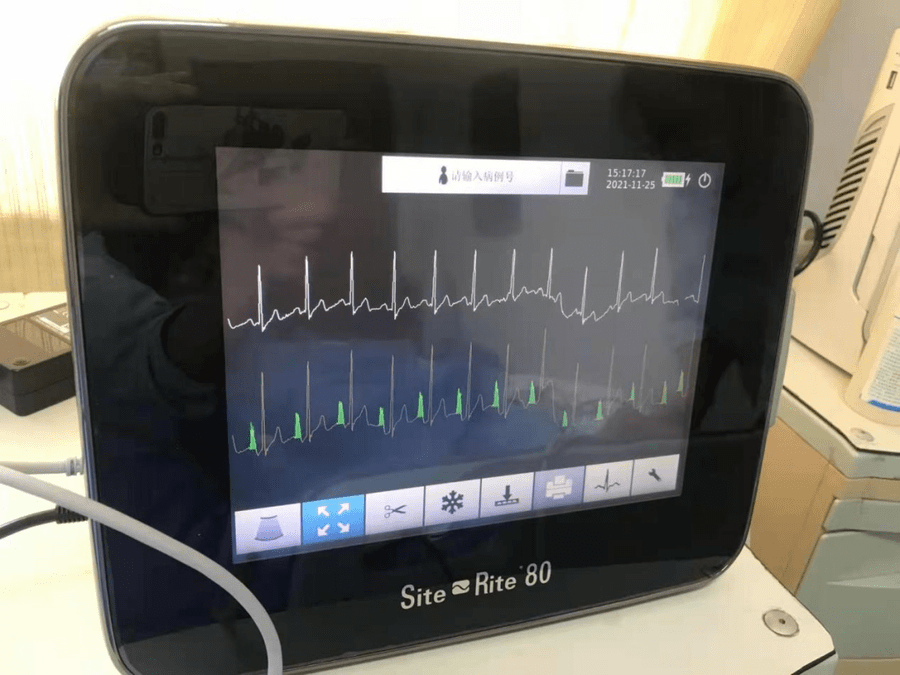 日照市中医医院成功开展3CG尖端定位系统在PICC中的应用_导管_静脉_心电图