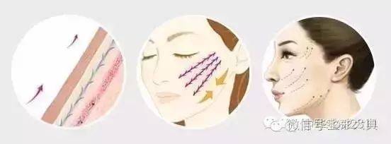 PPDO线雕丨科普篇_皮肤_提拉_锯齿