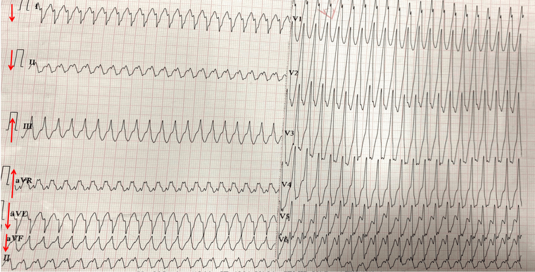 主任提问：宽 QRS 心动过速的 6 种鉴别方法，都是啥？_心室_心电图_患者