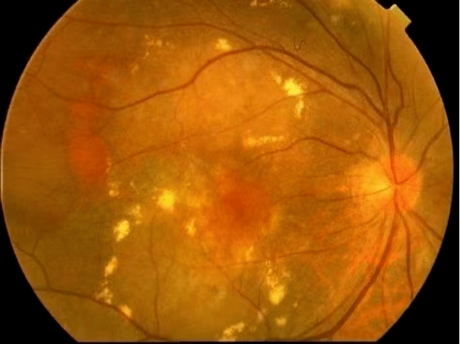 李筱荣教授谈视网膜下注射t-PA在PCV视网膜下出血中的应用_治疗_玻璃体_视力