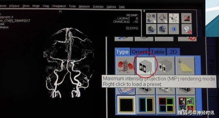 颅脑动脉系统及CTA检查技术，一文读懂_扫描_脑血管_疾病