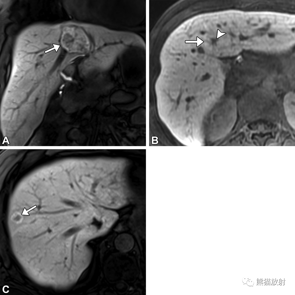 FNH及FNH样病变丨影像表现_信号_肝脏_中央