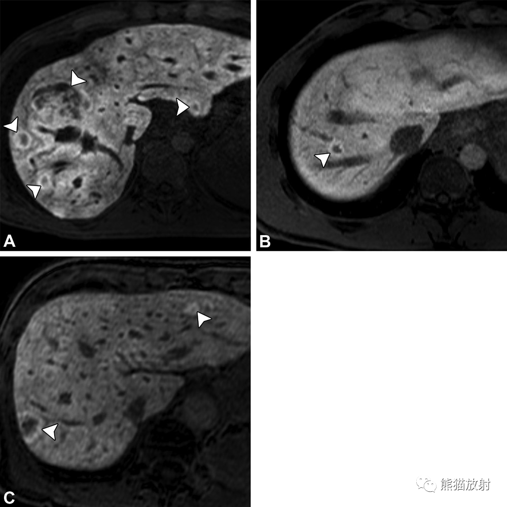 FNH及FNH样病变丨影像表现_信号_肝脏_中央