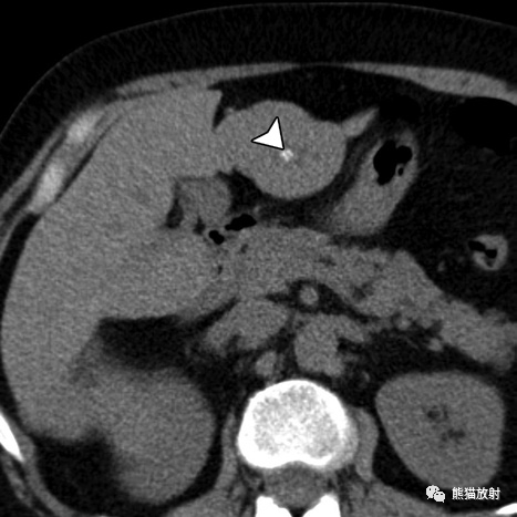 FNH及FNH样病变丨影像表现_信号_肝脏_中央