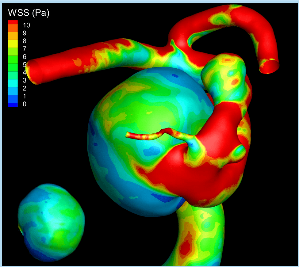 术说·第二十一期丨Surpass Streamline血流导向密网支架治疗颈内动脉多发动脉瘤初体验_中国医师协会_全国_导管