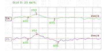 ERG| 视网膜电图详解_反应_闪光_图形
