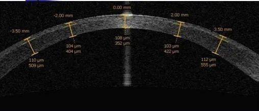 前段OCT | OCT在眼前节的应用_测量_角膜_成像