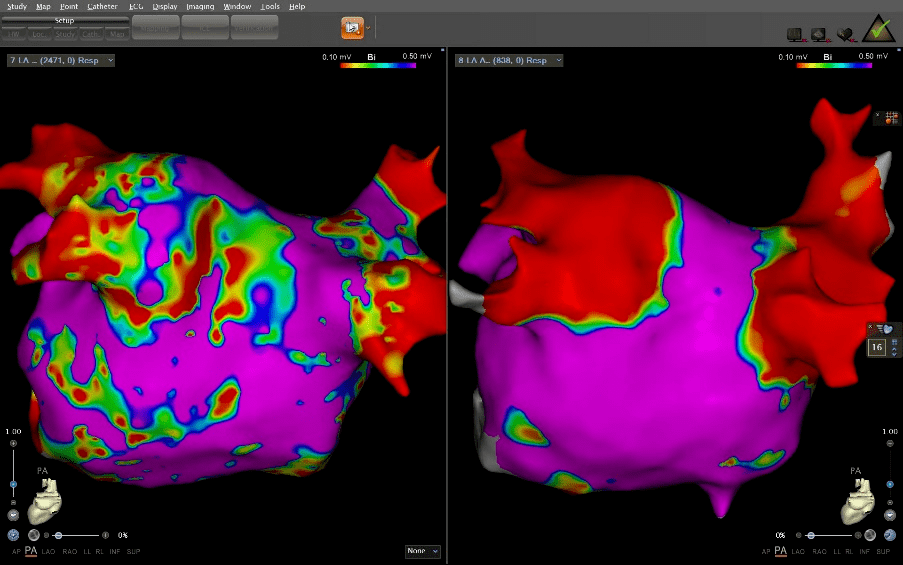 第一医疗 | 市一心内科刘少稳教授团队率先应用新型IRE三维脉冲消融系统完成脉冲射频消融手术_导管_患者_肺静脉