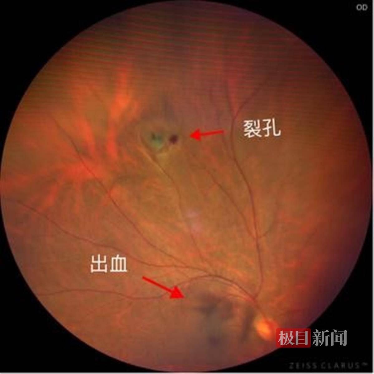 阳”后总感觉眼睛不舒服？专家提醒：出现这些情况不要大意患者陈中山病毒