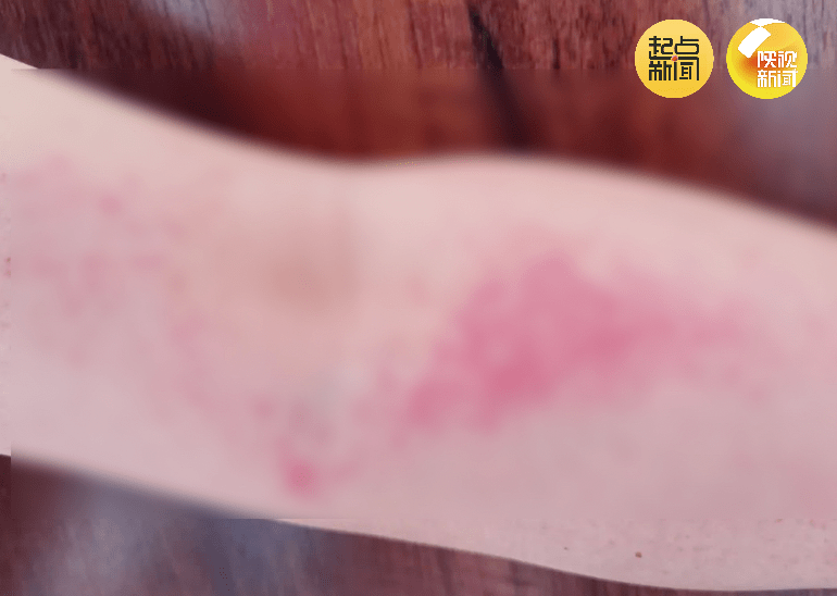 男子患“狒狒综合征” 起因是一根打碎的温度计……_水银_房间内_杨先生