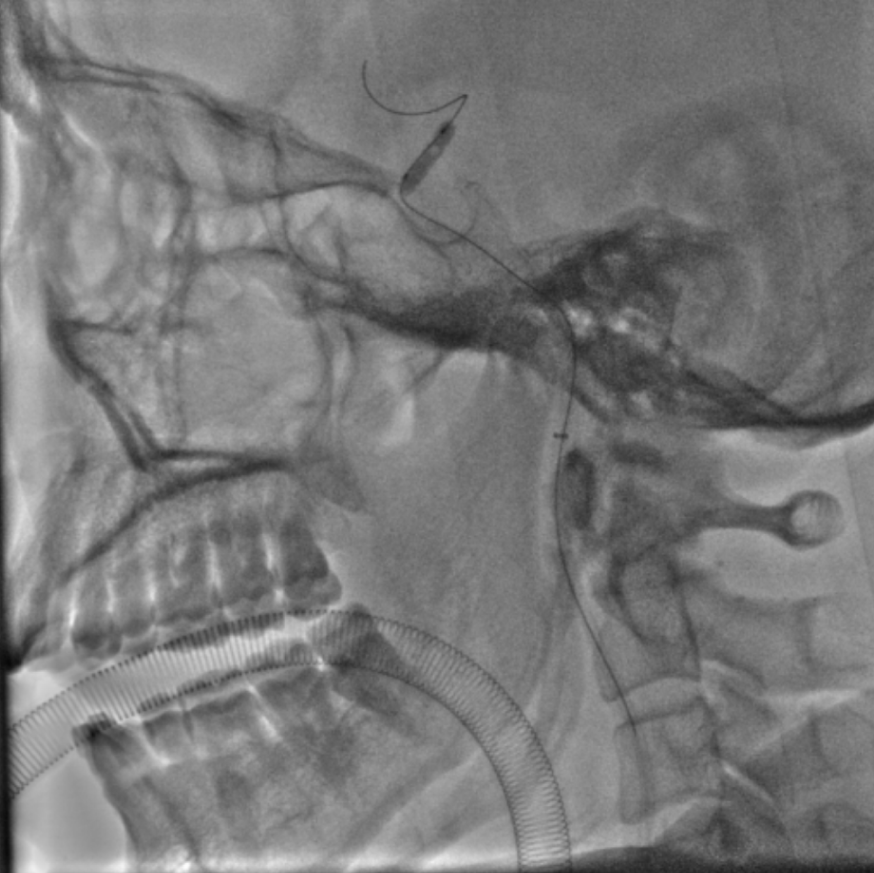 刘永康、程光森：Fluxcap球囊导引导管辅助颈内动脉闭塞开通_造影_cm_微导