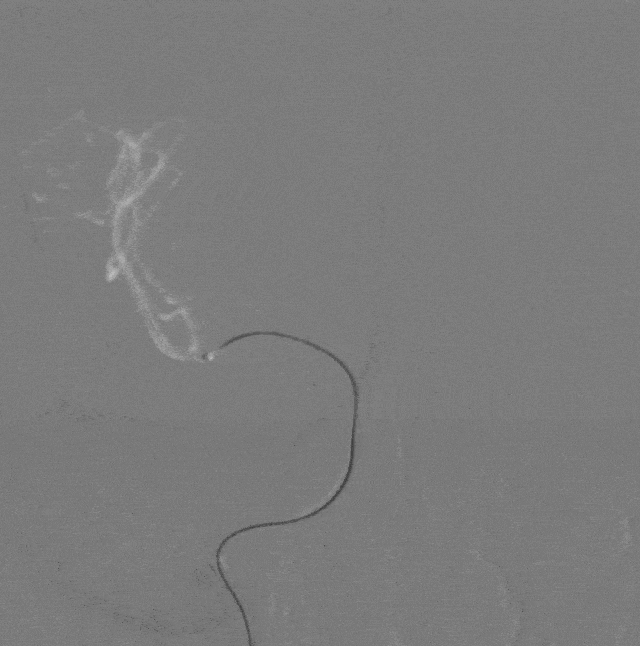 刘永康、程光森：Fluxcap球囊导引导管辅助颈内动脉闭塞开通_造影_cm_微导