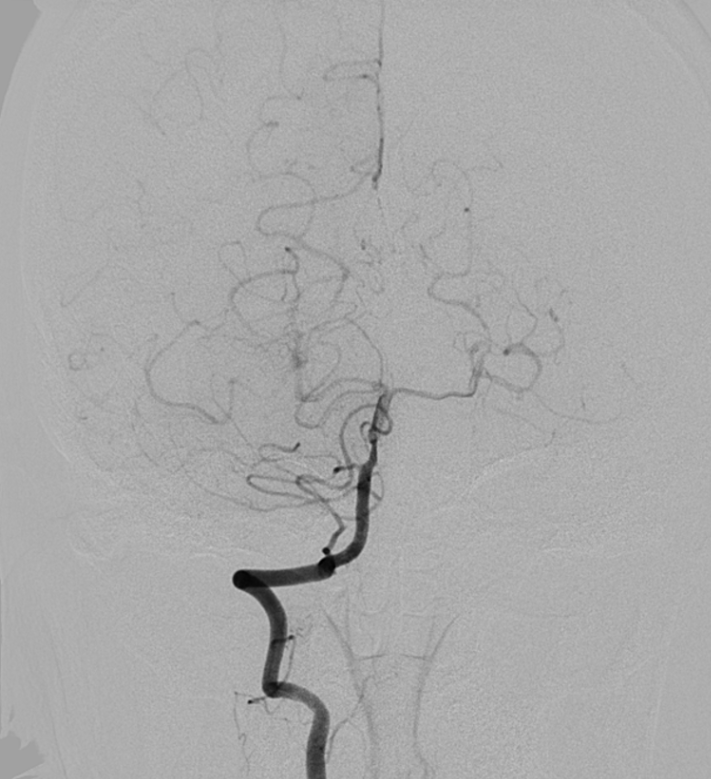 刘永康、程光森：Fluxcap球囊导引导管辅助颈内动脉闭塞开通_造影_cm_微导
