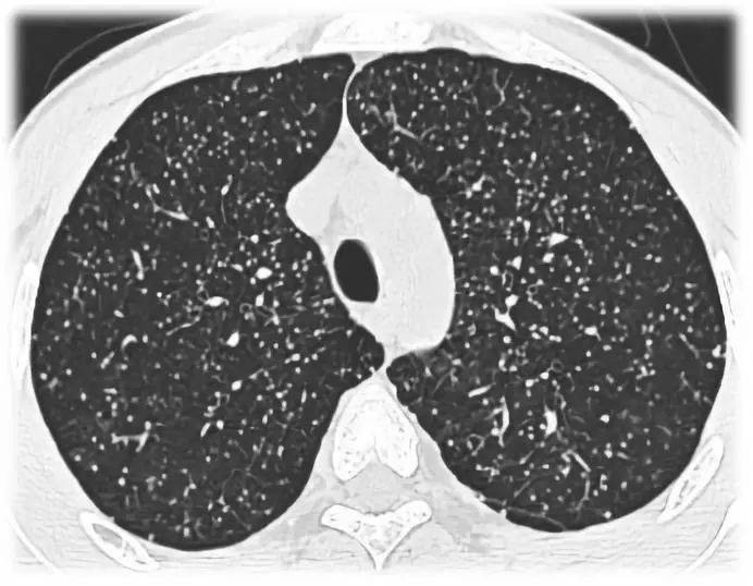 肺真菌感染怎么判断？牢记这「三多」_结核_肺部_课程