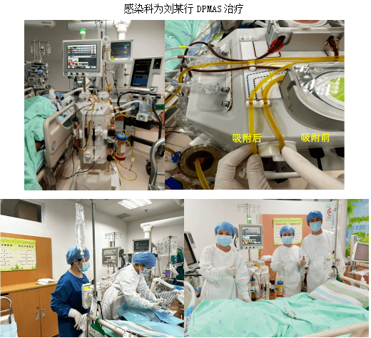 双“罐”齐下 重焕新生—我院DPMAS人工肝治疗拯救肝衰竭患者_吸附_血浆_救治